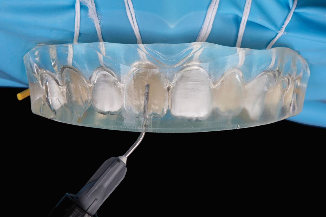 Composite Injection Moulding Technique – College of General Dentistry